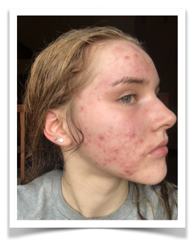 My Story - Life With Mils